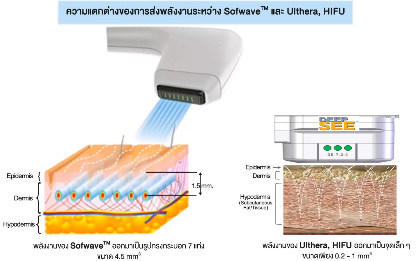 Sofwave แตกต่างจาก Ulthera อย่างไร?? ‘นพ.วิชัย หงส์จารุ’ มีคำตอบ.! – Dr.Wichai Laser Clinic